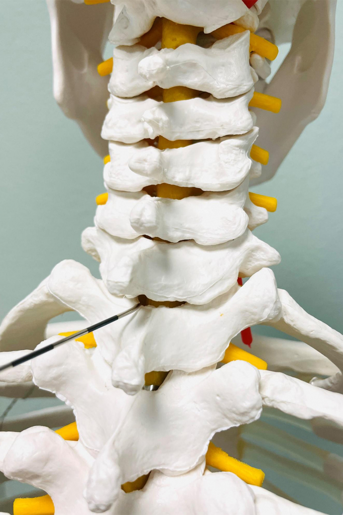 Cervical Epidural Steroid Injection Nerve And Pain Institute Cervical Epidural Steroid Injection Nerve And Pain Institute